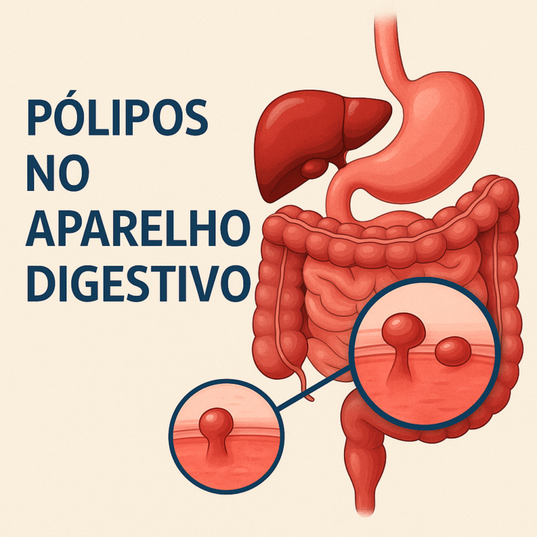 Pólipos no Aparelho Digestivo: O Que São, Riscos e Tratamentos